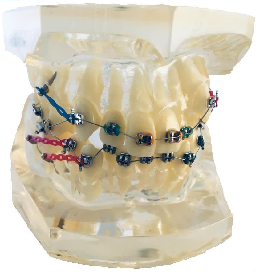 Modelo Ortodoncia con tratamiento Bracket, metálicos | Strongtek