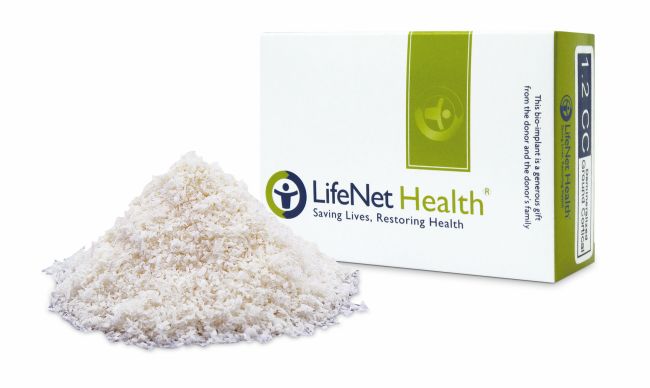 Aloinjertos LifeNet Health | Via Ossea