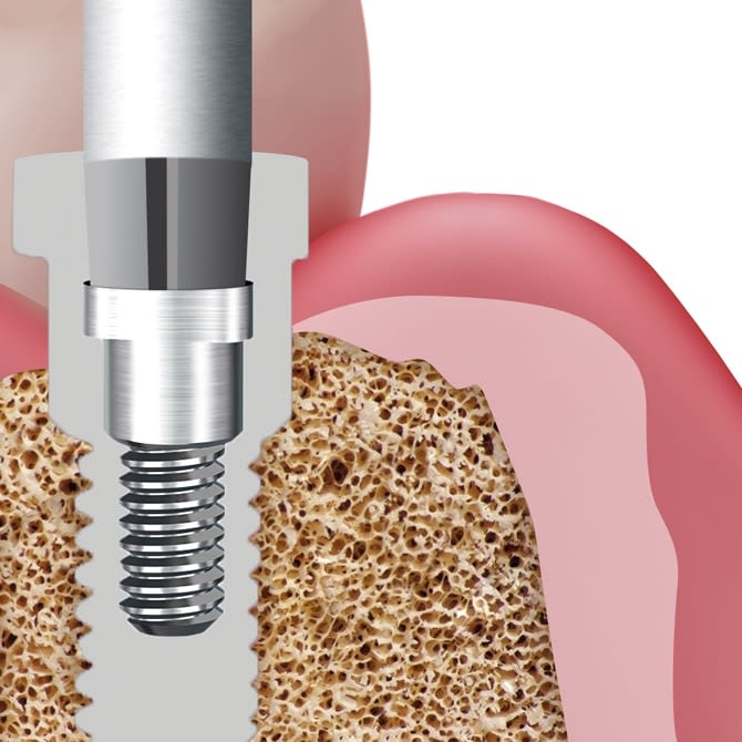 Silver Plug, caja 20 unidades | Biomateriales Chile
