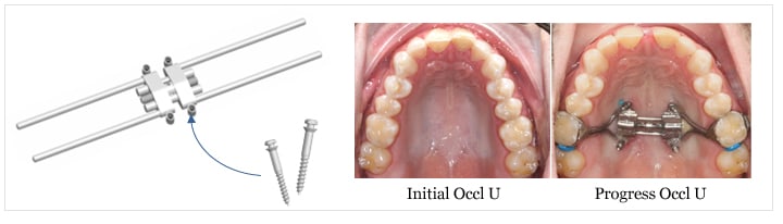 Kit MSE Inicial | Biomateriales Chile