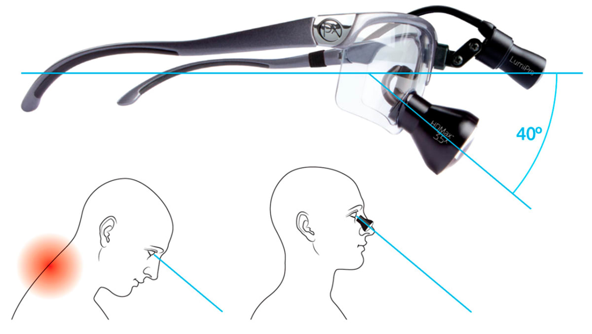 LUMIPRO HEADLIGHT SYSTEM IT PeriOptix | Biomateriales Chile